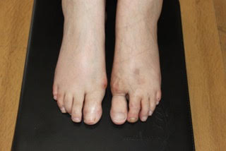 Cosmetic Silicon Toe – Ledbrook Clinic