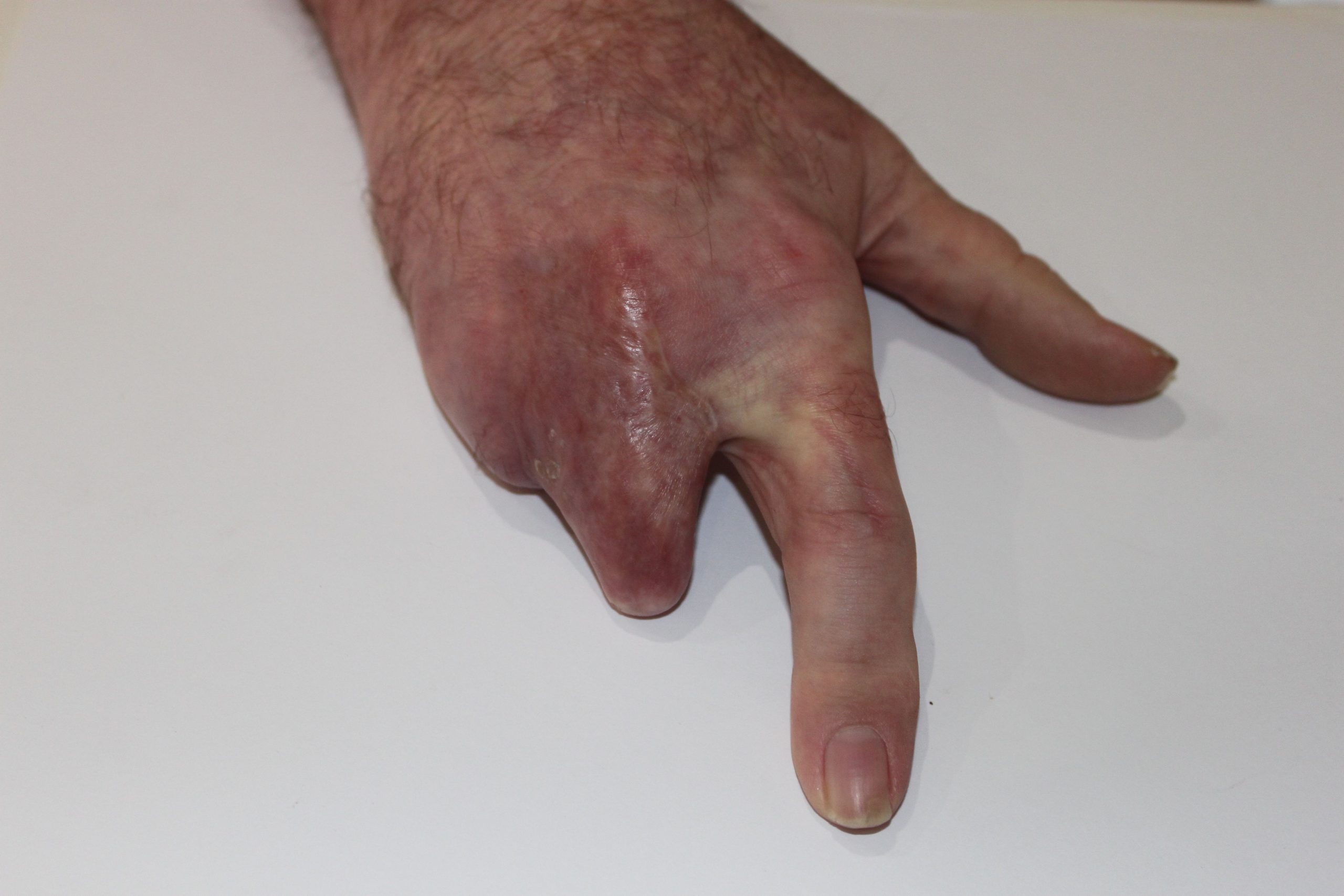Silicone Hands – Ledbrook Clinic